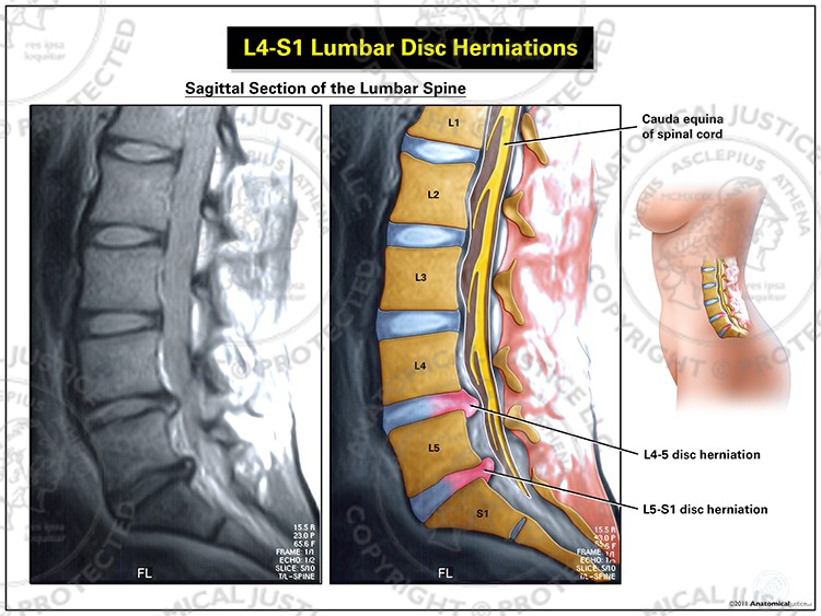 central herniation l5 s1 disc