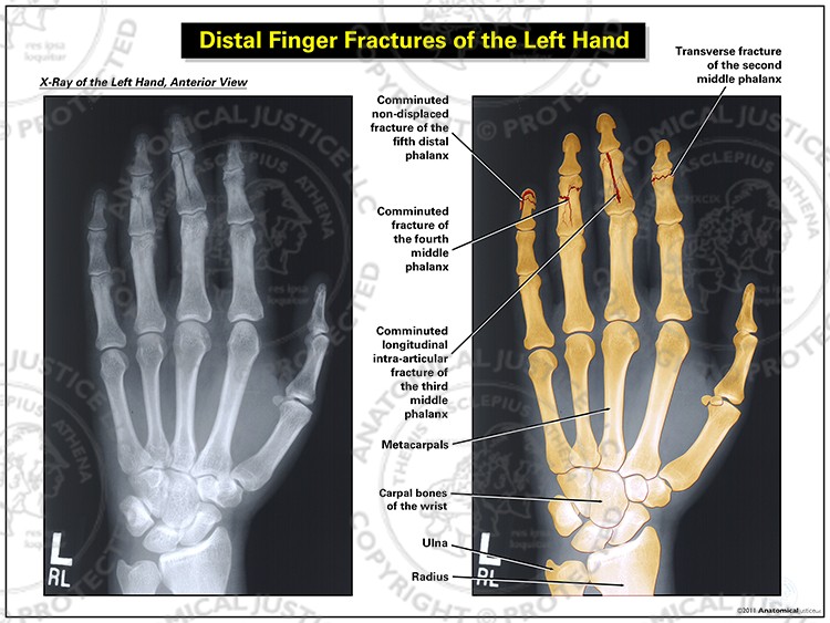 left hand bones