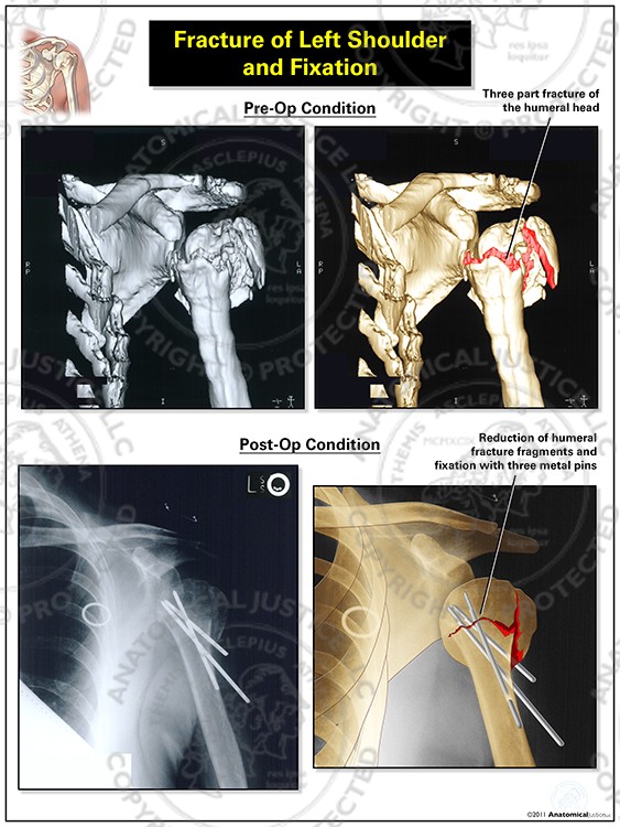 Fracture of the Left Shoulder and Fixation