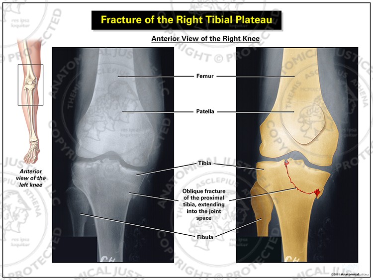 Fracture of the Right Tibial Plateau – Radiology Illustration & Legal ...