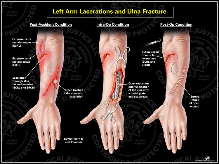 Left Ulna Fracture Left Ulna Fracture