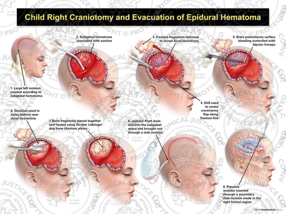 Subgaleal Hematoma Surgical Neurology International Subgaleal Hematoma Surgical Neurology International