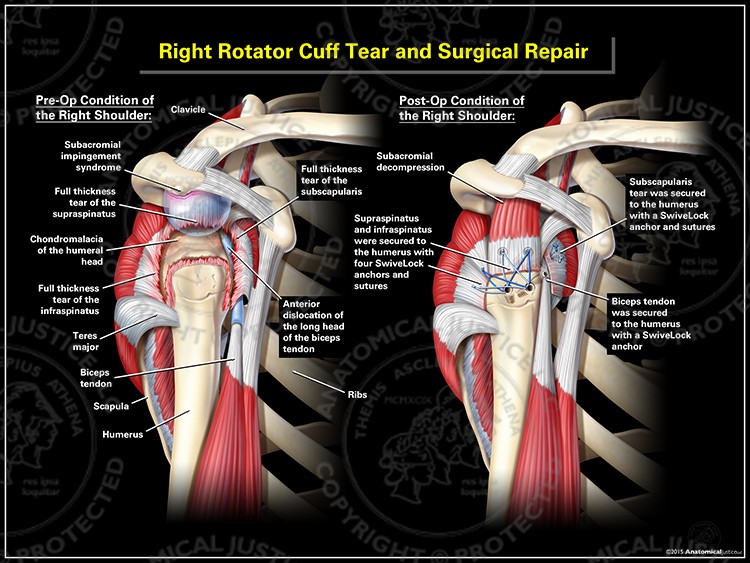 Right Rotator Cuff Tear And Surgical Repair Right Rotator Cuff Tear And Surgical Repair