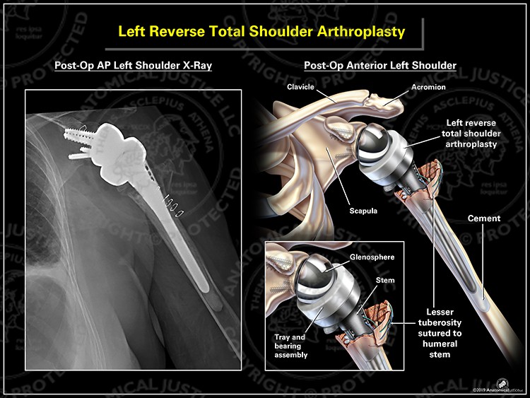 Left Reverse Total Shoulder Arthroplasty Left Reverse Total Shoulder Arthroplasty
