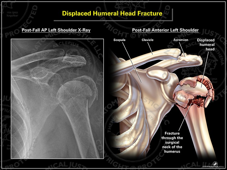 Displaced Humeral Head Fracture Displaced Humeral Head Fracture