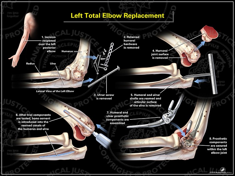 Left Reverse Total Shoulder Arthroplasty Left Reverse Total Shoulder Arthroplasty