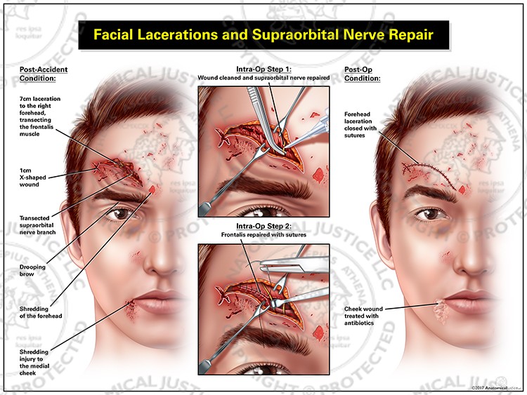 Facial Laceration