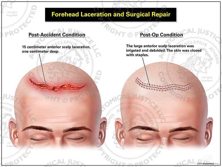 Posterior Head Laceration Icd 10