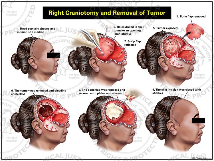 Right Craniotomy And Removal Of Tumor Right Craniotomy And Removal Of Tumor