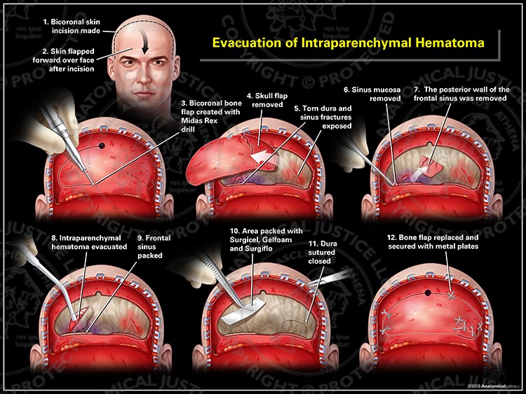 Evacuation Of Intraparenchymal Hematoma Evacuation Of Intraparenchymal Hematoma
