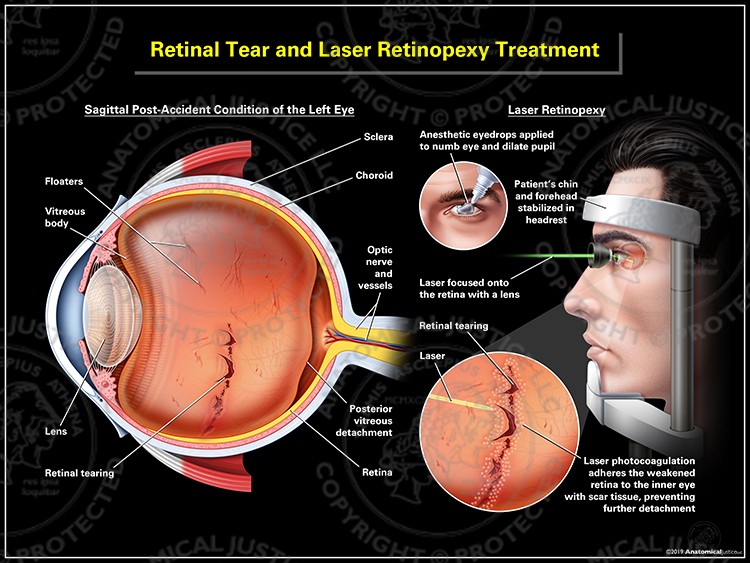 Laser Retinopexy Treatment For Retinal Tear Laser Retinopexy Treatment For Retinal Tear
