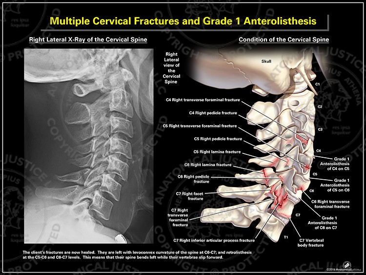 Cervical Spine Fractures Archives Anatomical Justice