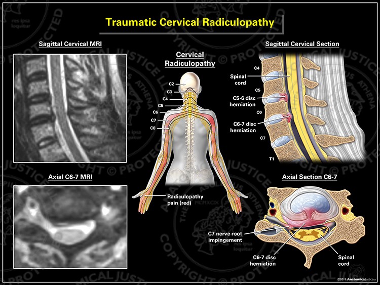 Cervical Nerve Roots Radiology Cervical Nerve Roots Radiology
