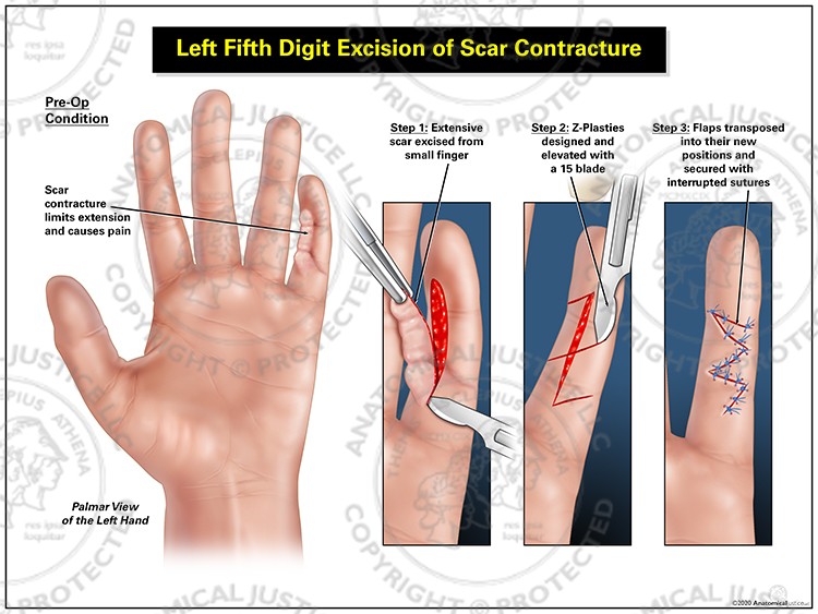 Left Fifth Digit Excision of Scar Contracture