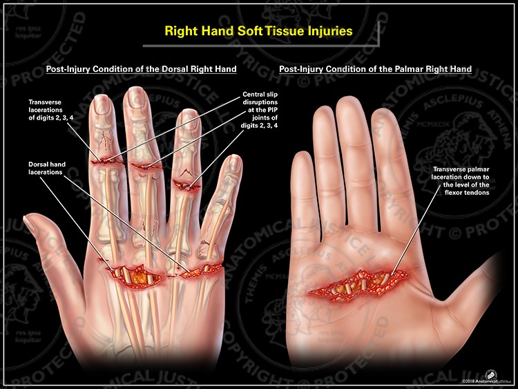 Right Hand Lacerations And Central Slip Injuries