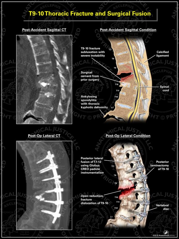 T9-10 Thoracic Fracture and Surgical Fusion