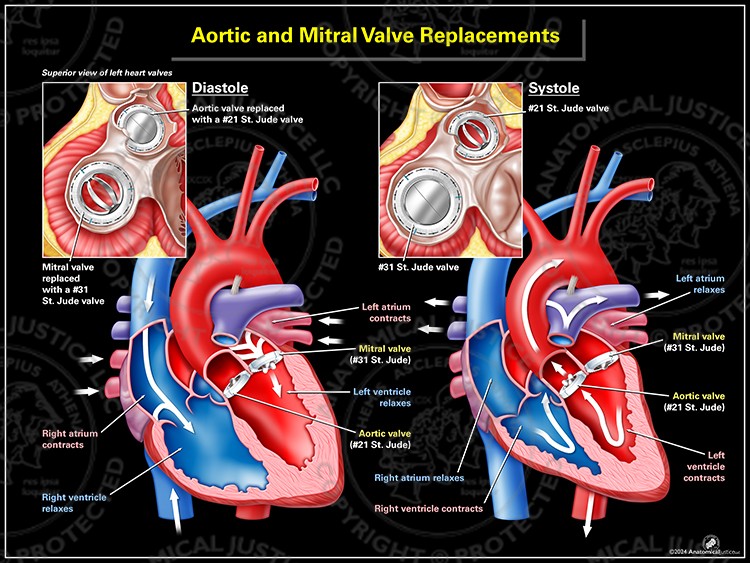 Aortic And Mitral Valve Replacements Aortic And Mitral Valve Replacements