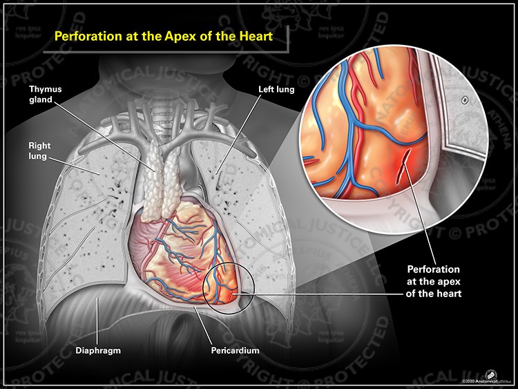 Perforation at the Apex of the Heart